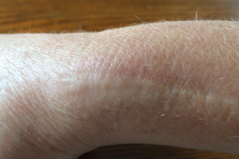 Narben, Narbenentstörung Heilpraktikerin Tina Ohl in Friedberg